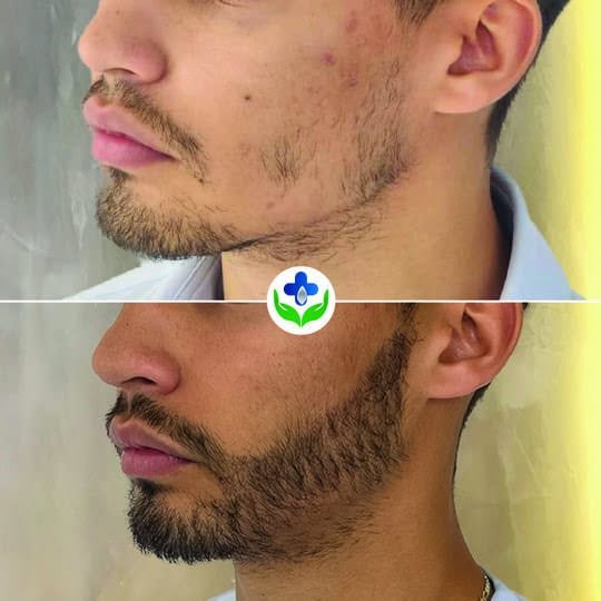 The Ultimate Destination for women hair Transplant in Colombia